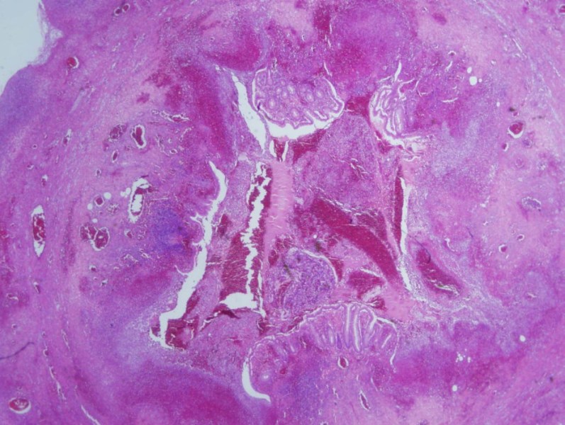 Laboratorij za virtualnu mikroskopiju - Slika 2. Akutna upala crvuljka ...