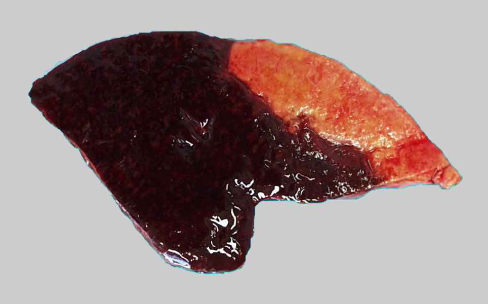 Laboratorij za virtualnu mikroskopiju - Slika 4. Infarkt slezene (makro)