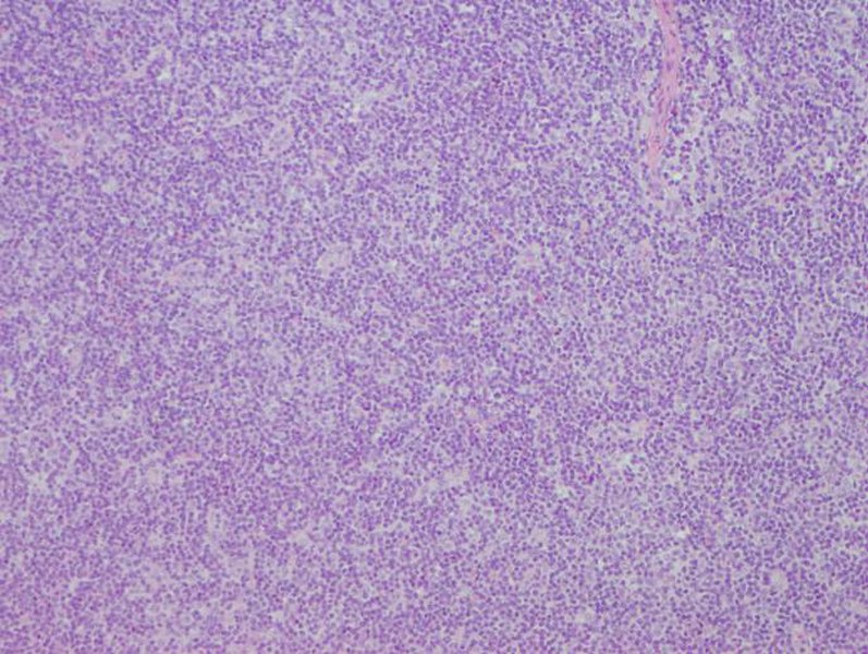 Laboratorij za virtualnu mikroskopiju - Slika 10. Ne-Hodgkinov limfom ...