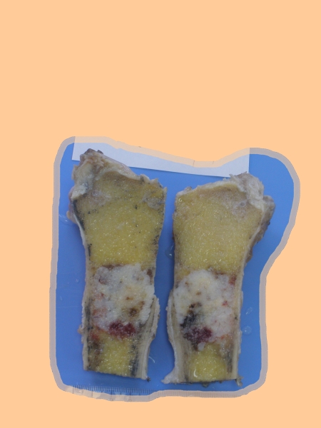 Laboratorij za virtualnu mikroskopiju - Slika 5. Hondrosarkom (makro)