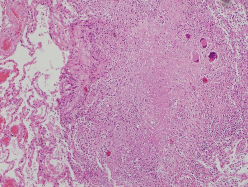 Laboratorij za virtualnu mikroskopiju - Slika 1. Tuberkuloza (mikro)