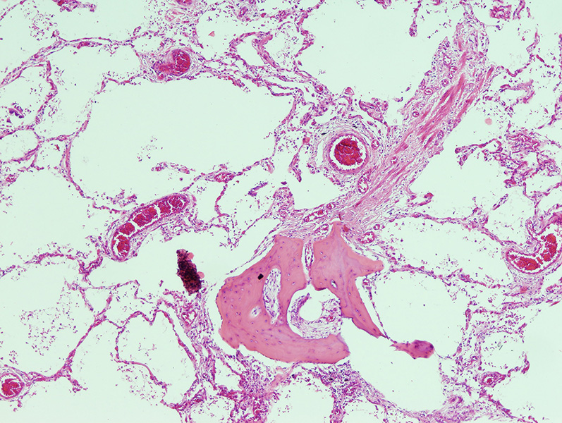 Laboratorij za virtualnu mikroskopiju - Slika 4. Koštana metaplazija ...