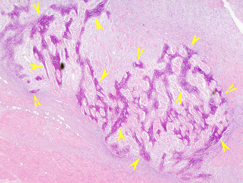 Laboratorij za virtualnu mikroskopiju - Slika 6. Koštana metaplazija ...