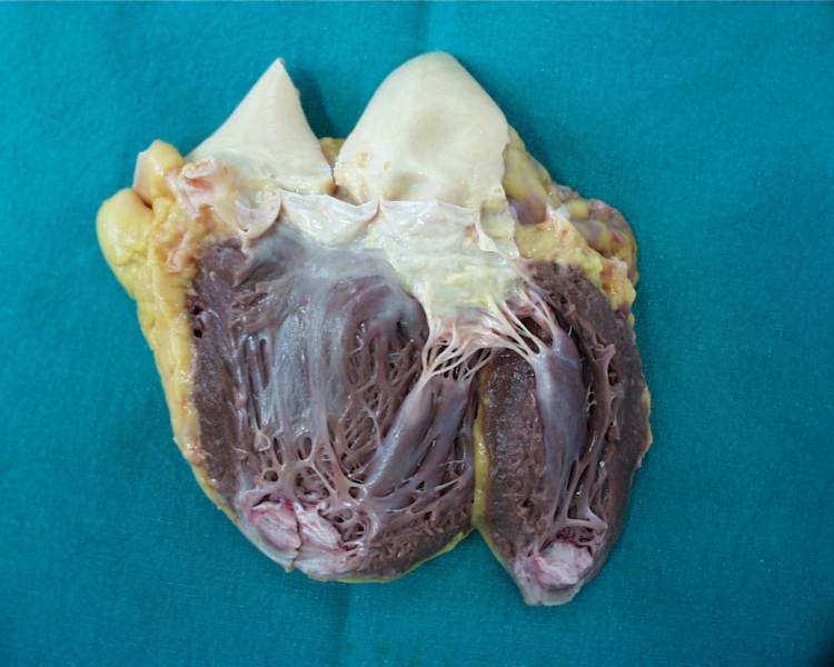 Laboratorij za virtualnu mikroskopiju - Slika 6. Muralni tromb (makro)